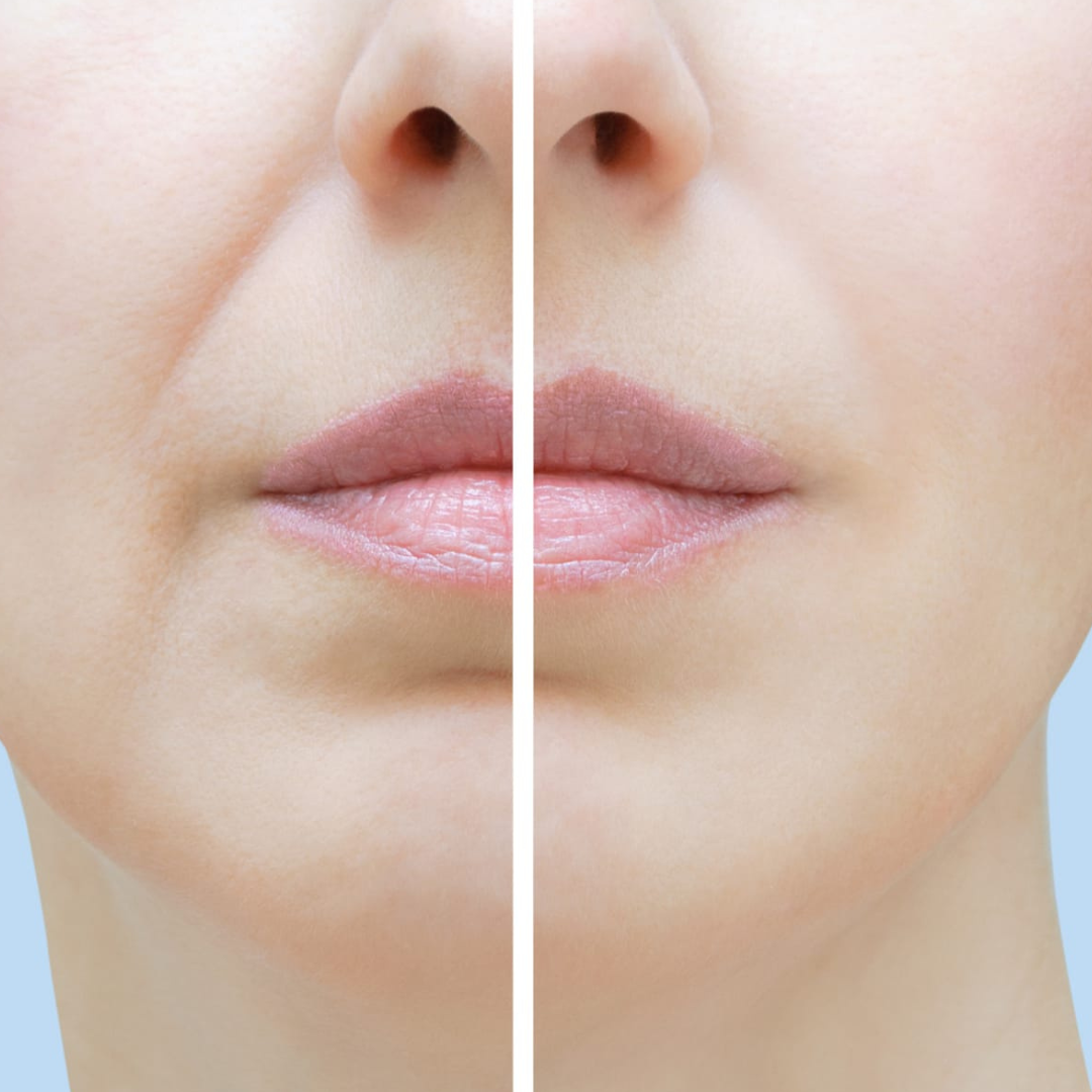 Filler For Nasolabial Folds