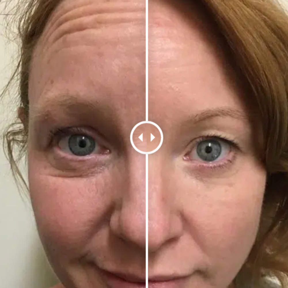 Scarlet RF Microneedling