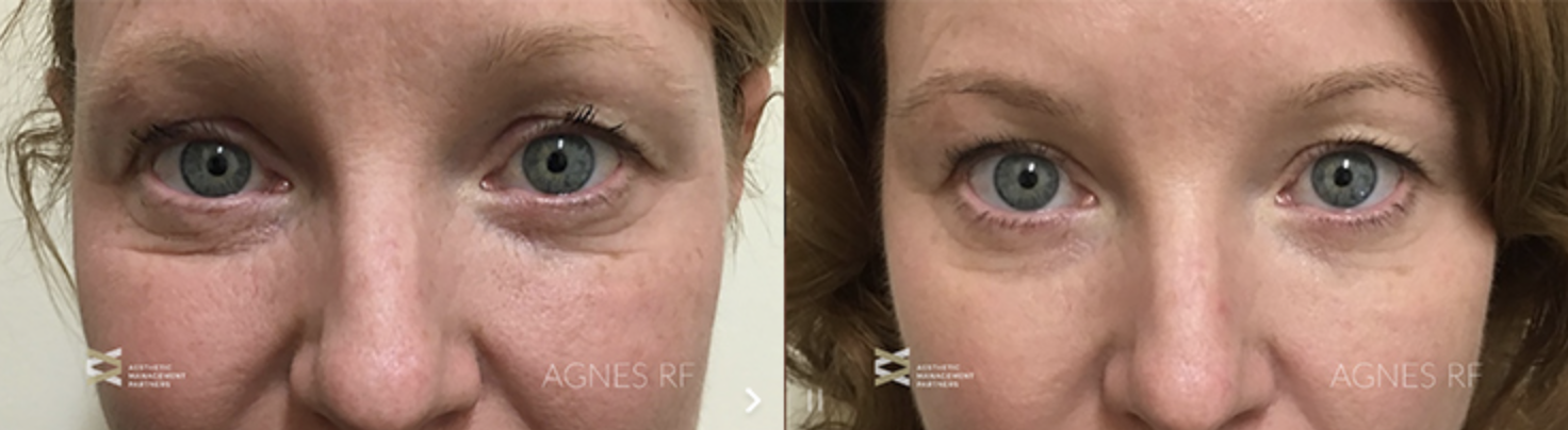 Agnes Precision RF Microneedling For Eye Bags – Victory Wellness ...